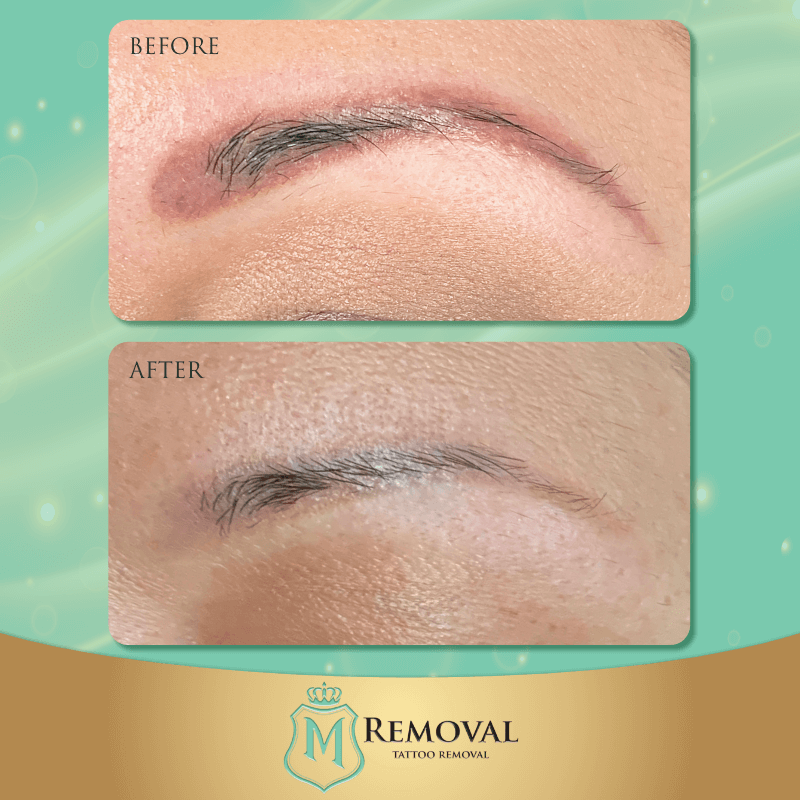 Permanentinio makiažo šalinimas | Tatuiruočių šalinimas