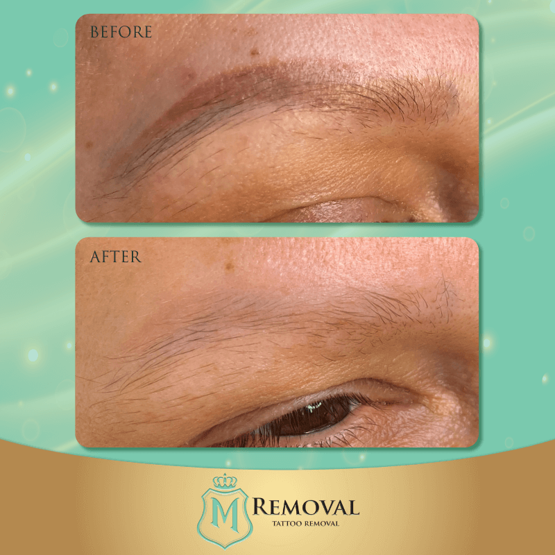 Permanentinio makiažo šalinimas | Tatuiruočių šalinimas