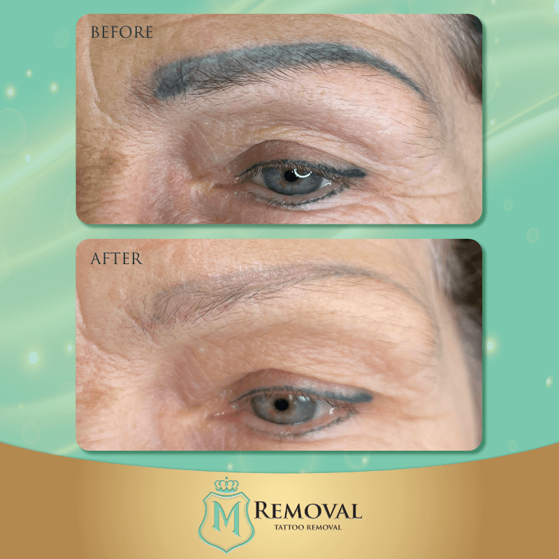 Permanentinio makiažo šalinimas | Tatuiruočių šalinimas