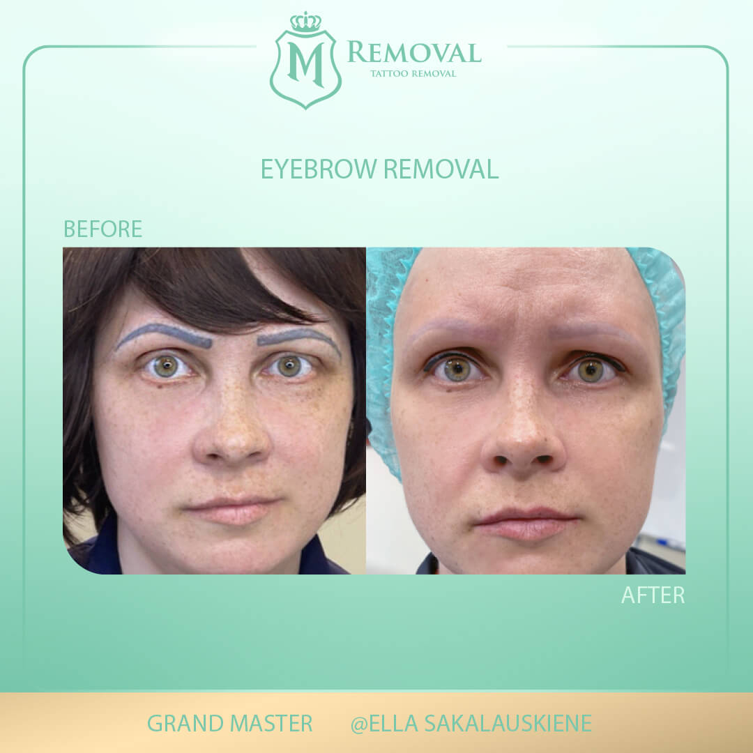 Permanentinio makiažo šalinimas | Tatuiruočių šalinimas