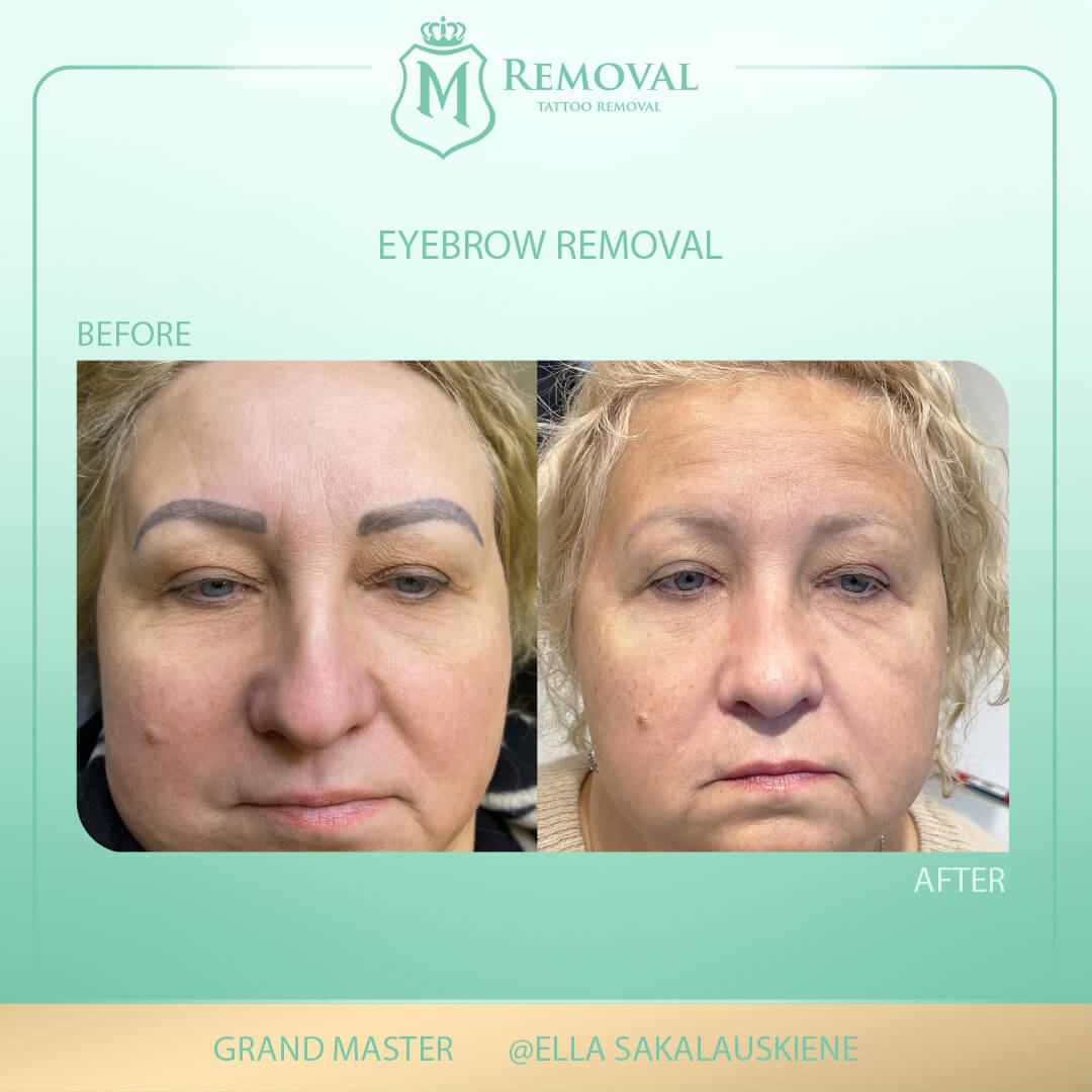 Permanentinio makiažo šalinimas | Tatuiruočių šalinimas