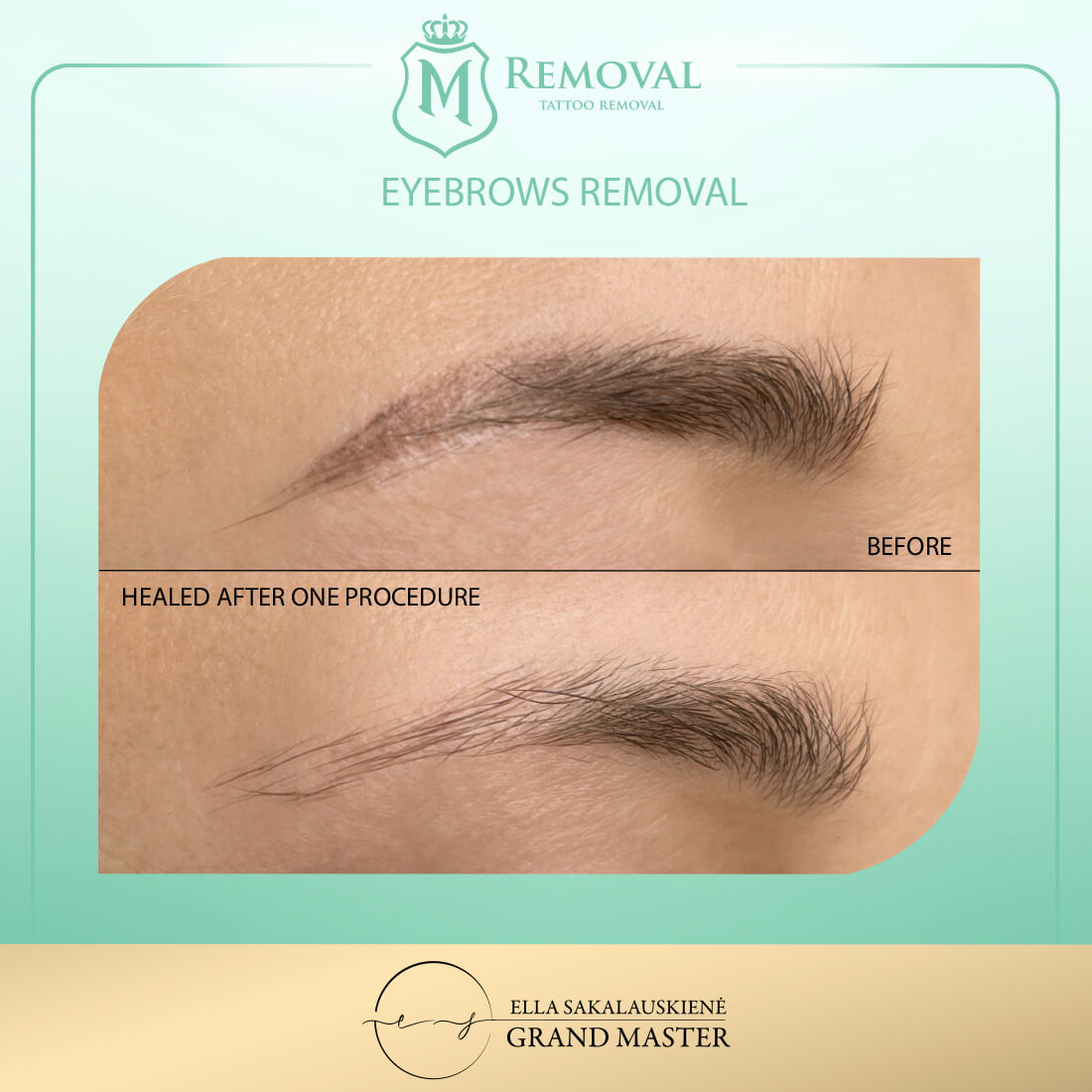Permanentinio makiažo šalinimas | Tatuiruočių šalinimas