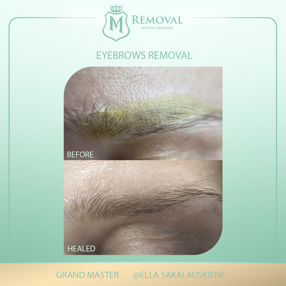 Permanentinio makiažo šalinimas | Tatuiruočių šalinimas